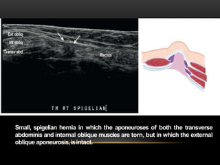 Spigelian Hernia Ultrasound
