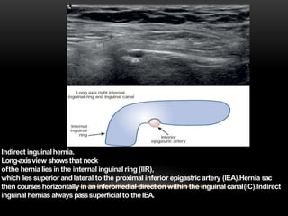 Indirect Inguinal Hernia Ultrasound