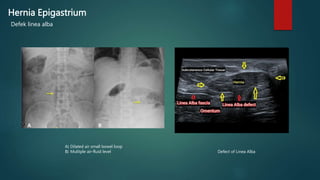 HERNIA - samuel.pptx