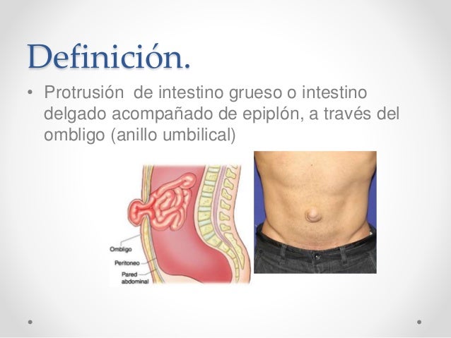 Hernia umbilical-cirugía