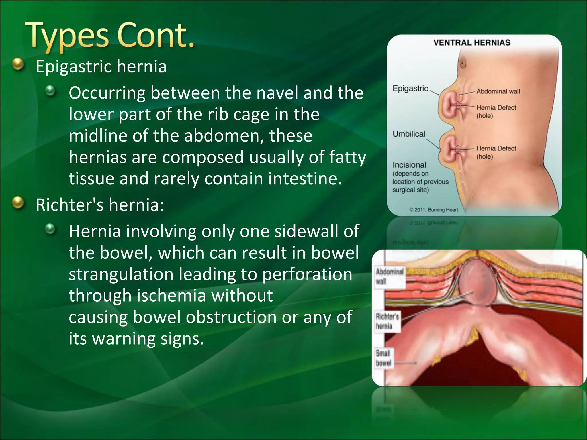 Hernia yashwant kumar. | PPT