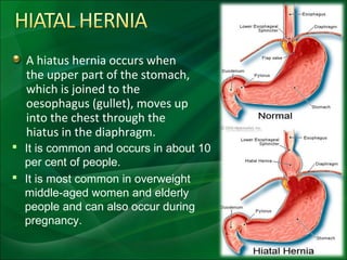 Hernia yashwant kumar. | PPT