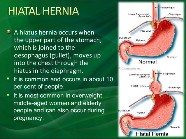 Hernia yashwant kumar.