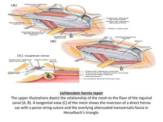 Direct Inguinal Hernia Netter