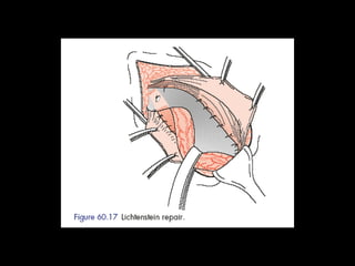 HERNIA12.pdf