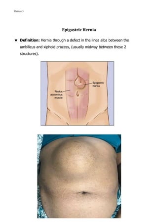 Hernia it's etiology types and incidents and plan of management of each ...