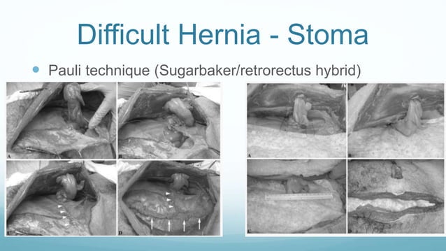 Hernia and Abdominal Wall Reconstruction: Peri-Operative Management | PPT