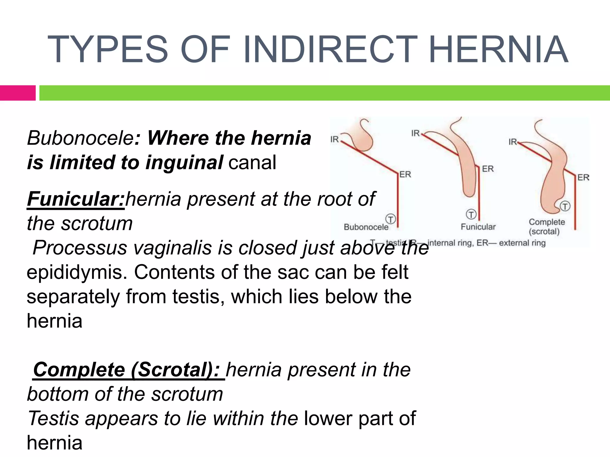 Hernia | PPTX
