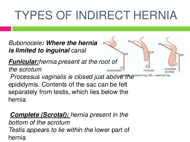 Hernia