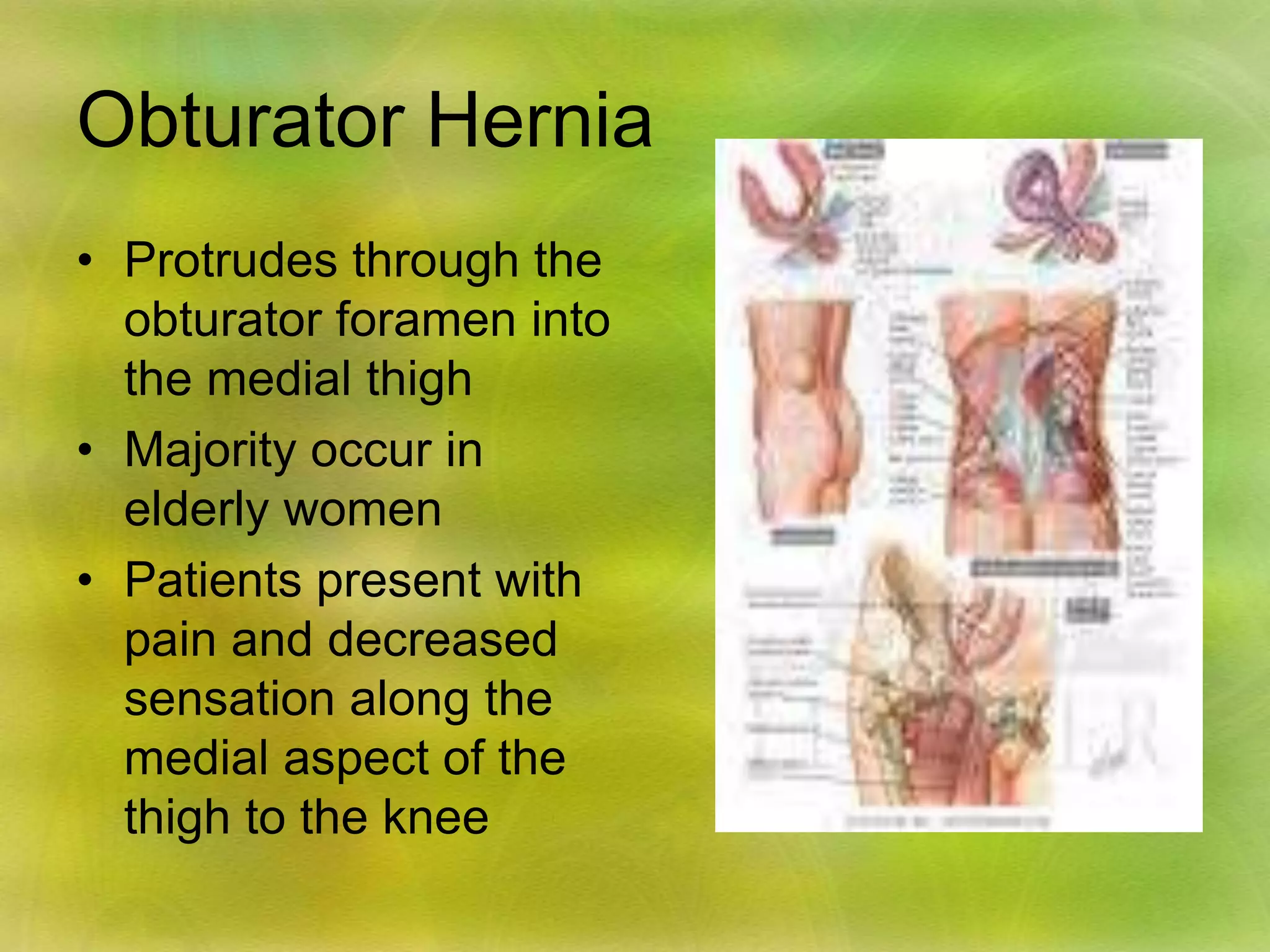 Hernia | PPT