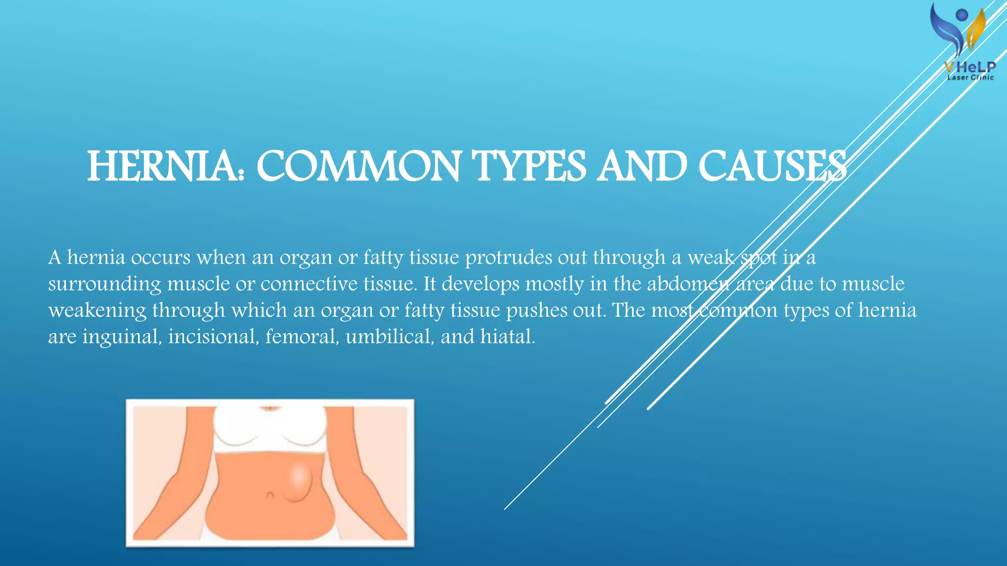 Hernia: common types and causes | PPTX