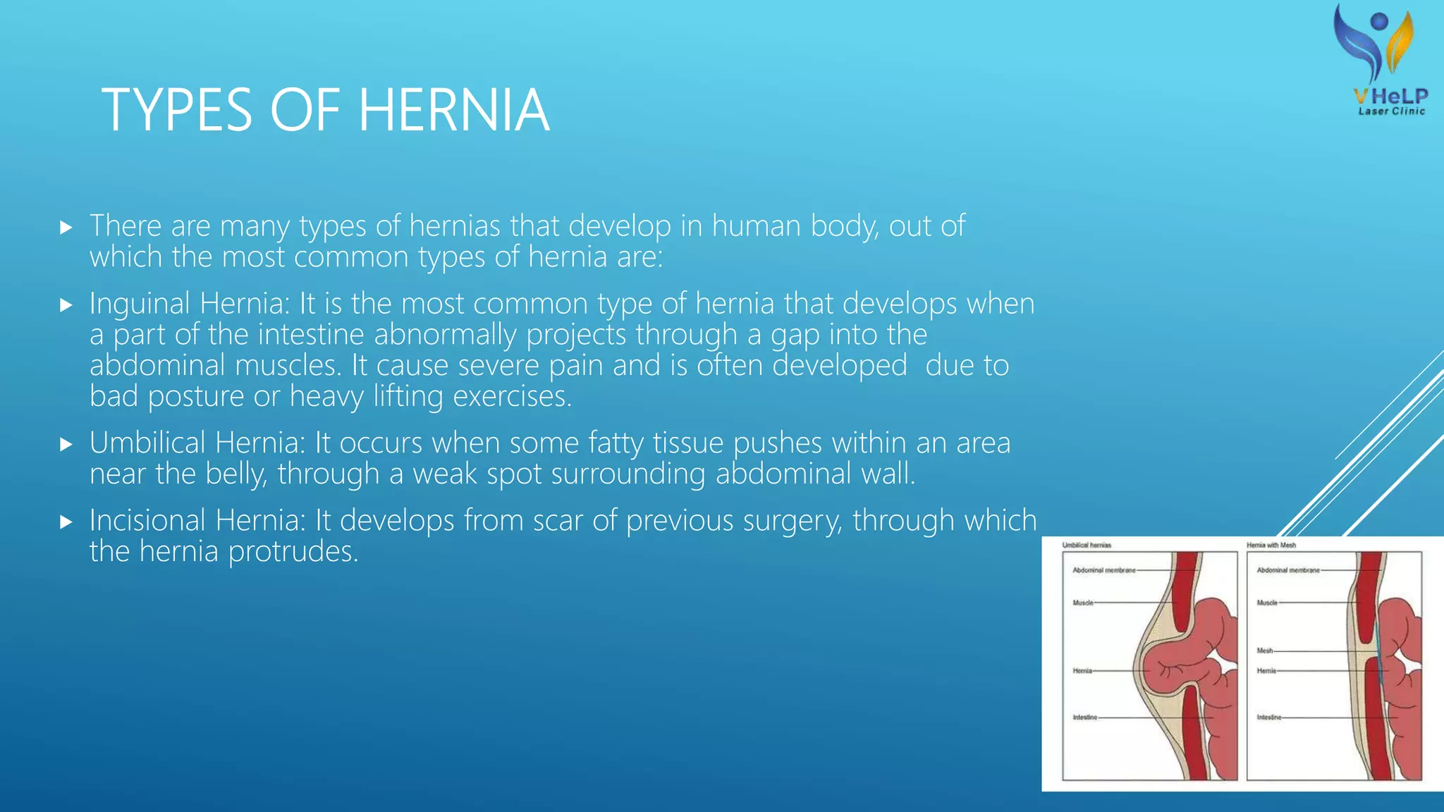 Hernia: common types and causes | PPTX