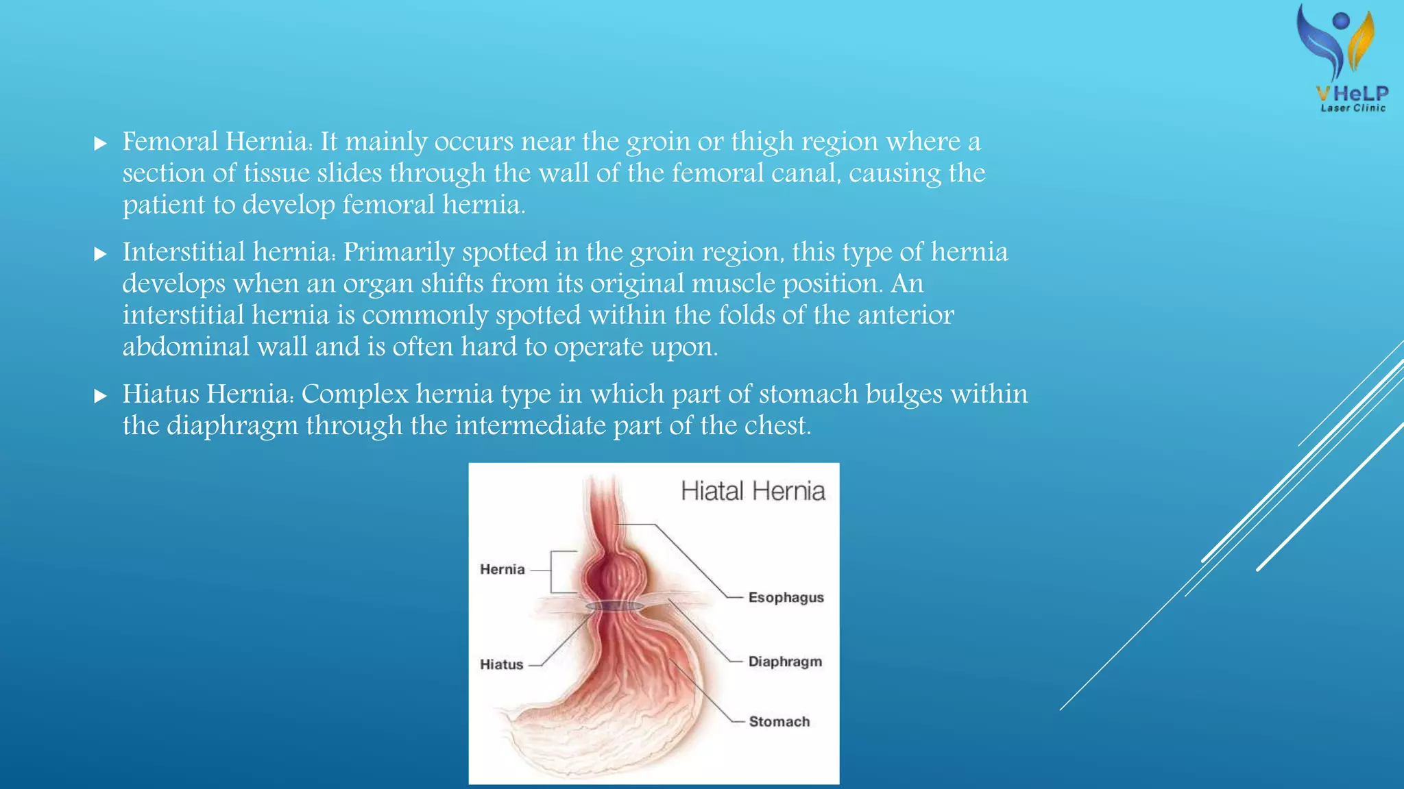 Hernia: common types and causes | PPTX