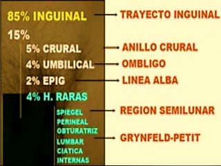 Hernia crural o femoral | PPT
