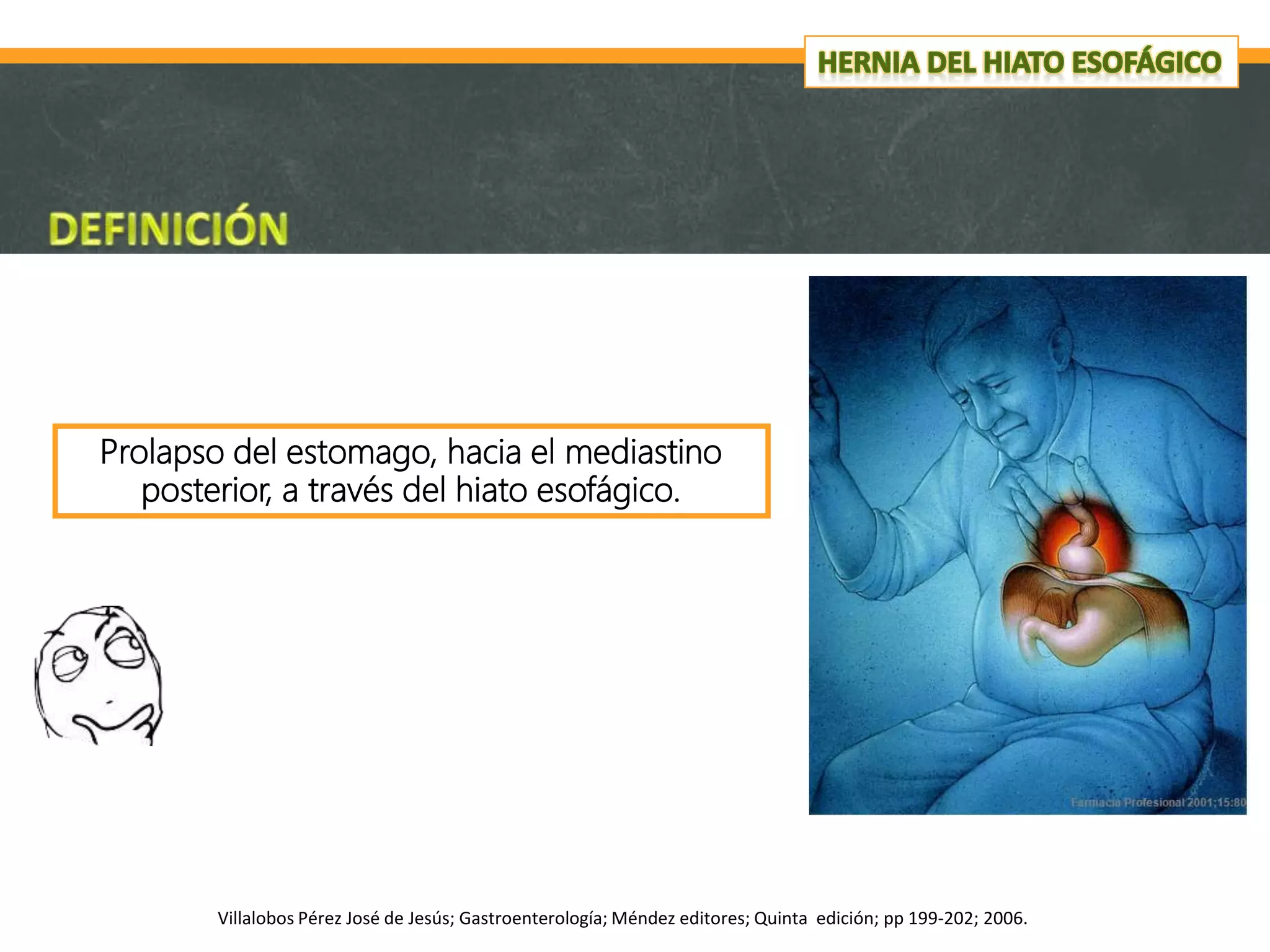 Hernia del hiato esofagico 2 | PPT