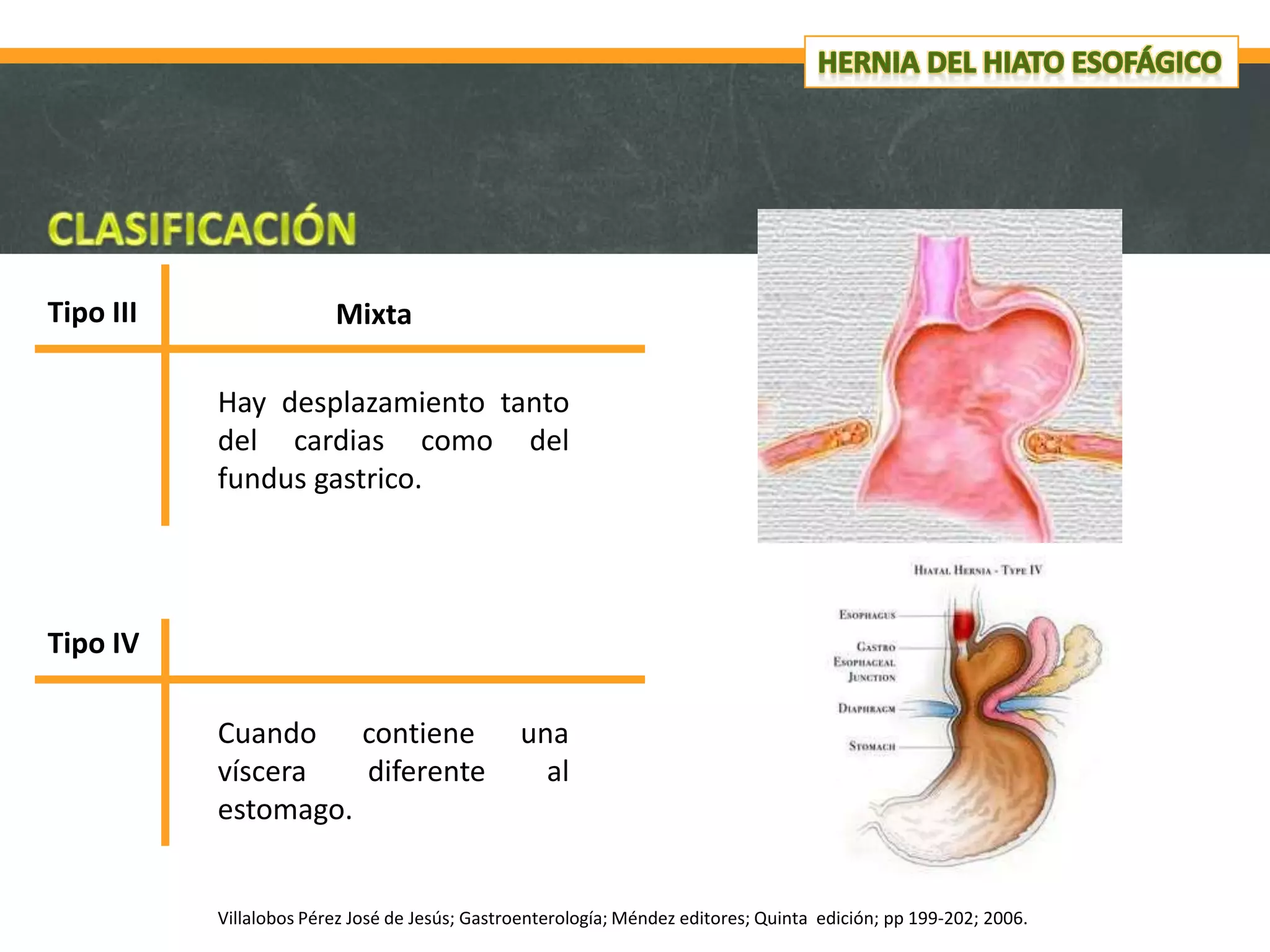 Hernia del hiato esofagico 2 | PPT