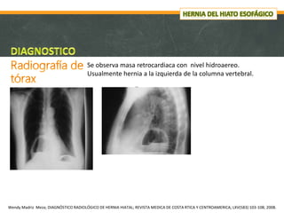 Hernia del hiato esofagico 2 | PPTX