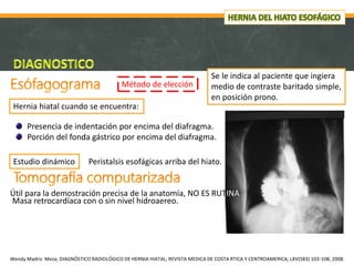 Hernia del hiato esofagico 2 | PPTX