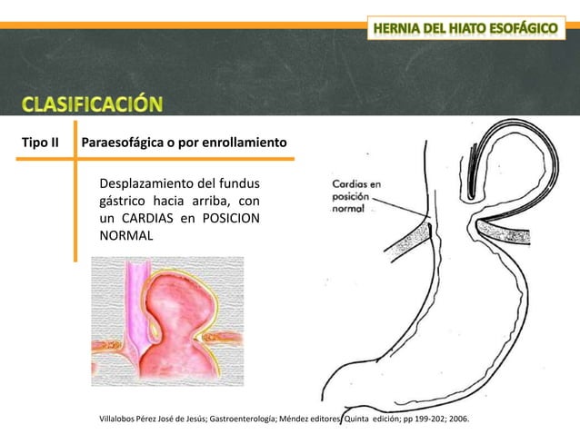Hernia del hiato esofagico 2 | PPT