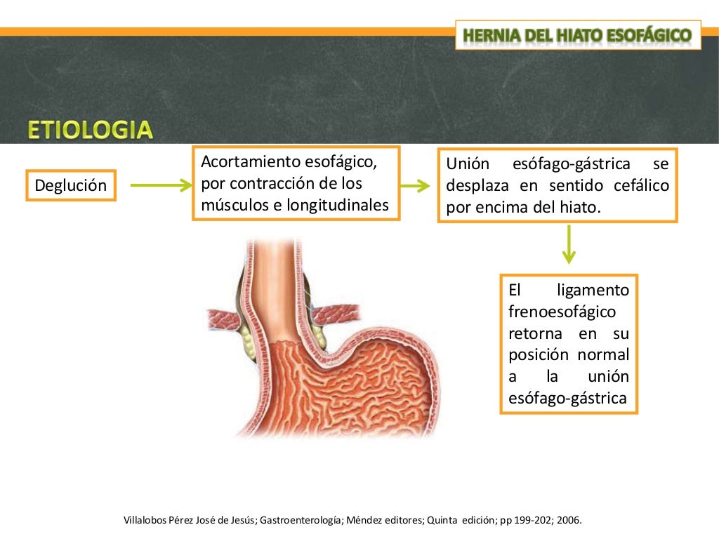 Hernia del hiato esofagico 2