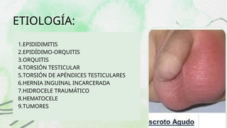 Escroto Agudo en pediatría, un tema de alto impacto | PPTX