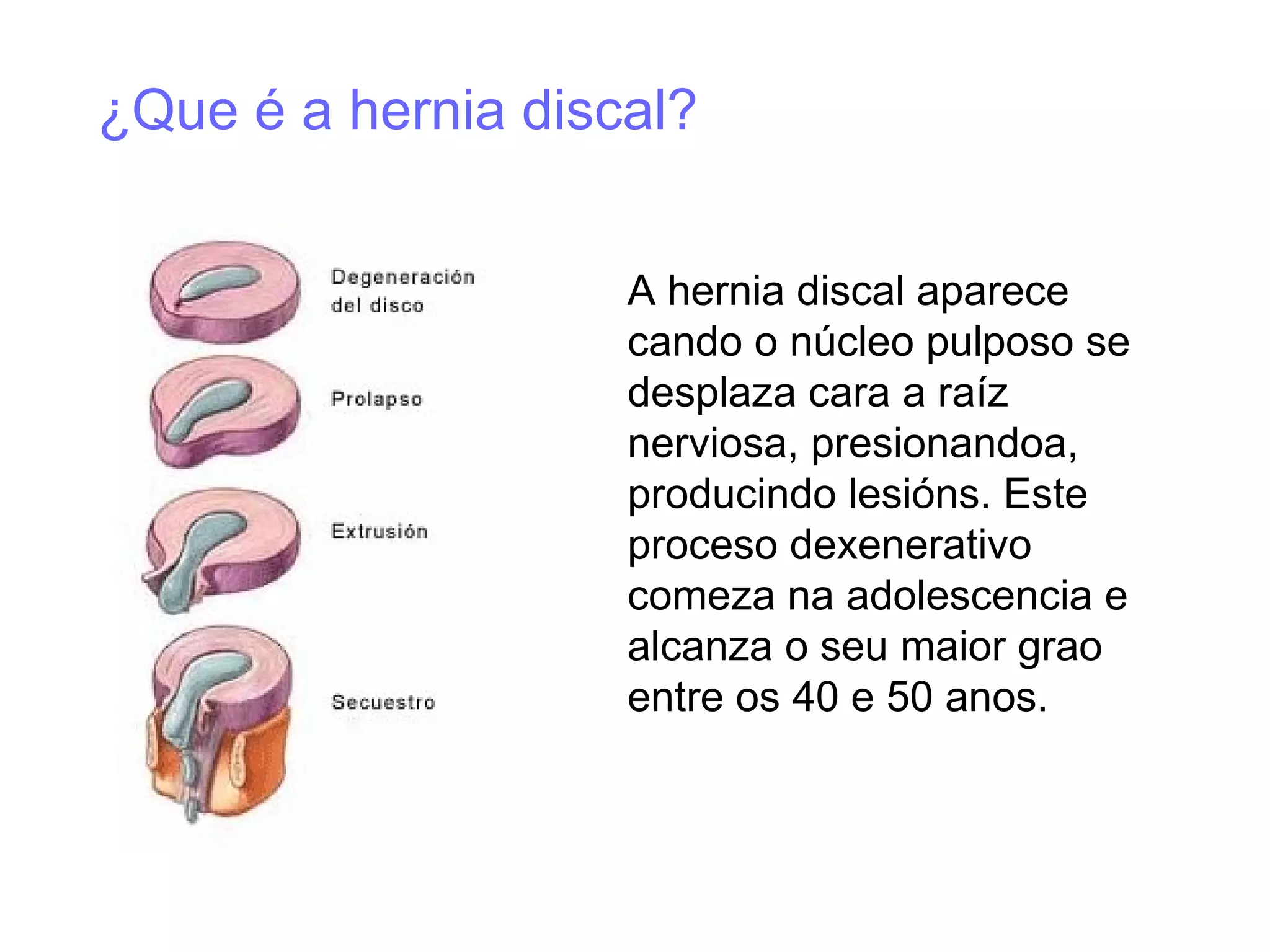 Hernia Discal | PPT
