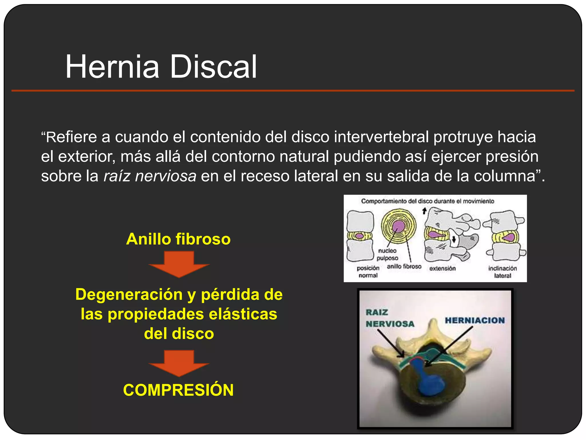 Hernia discal | PPTX | Physical Therapy | Wellness