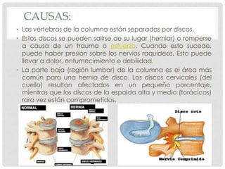 Hernia discal | PPTX