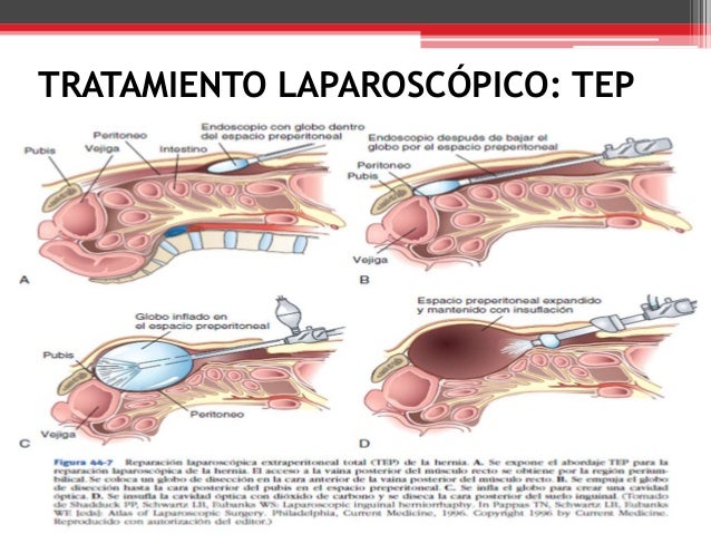 Hernia femoral o crural
