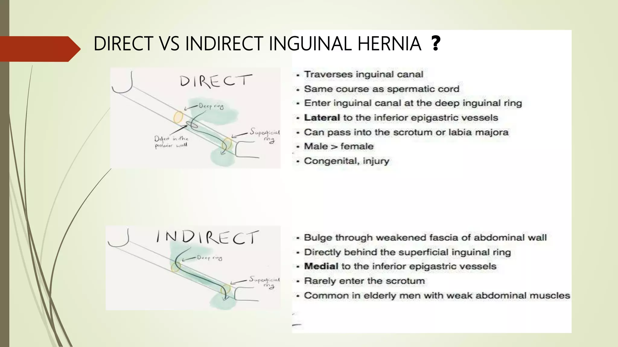 UG CASE PRESENTATION ON INGUINAL HERNIA | PPTX