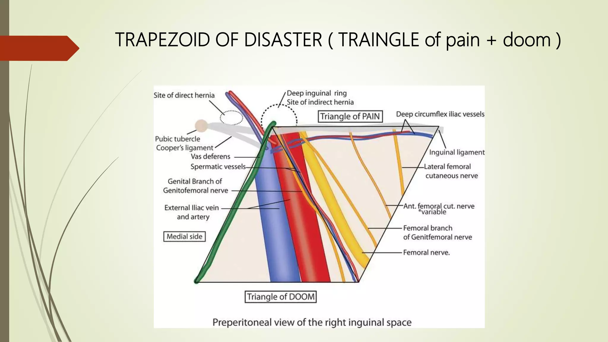 UG CASE PRESENTATION ON INGUINAL HERNIA | PPTX