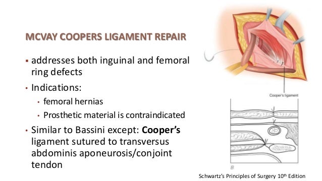 Cooper Ligament Hernia