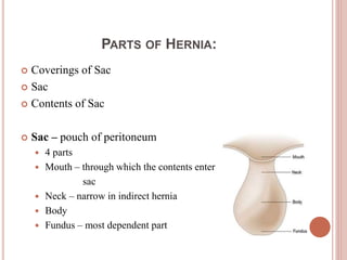 Inguinal Hernia .pptx