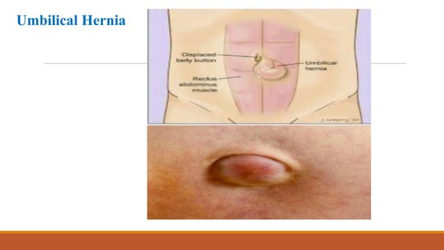 Hernia for nursing | PDF | Digestive Disorders | Diseases and Conditions