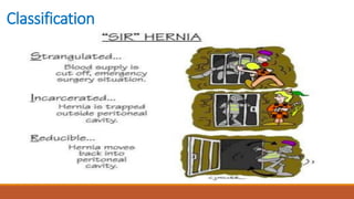 Hernia for nursing | PDF