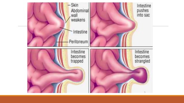 Hernia for nursing | PDF | Digestive Disorders | Diseases and Conditions