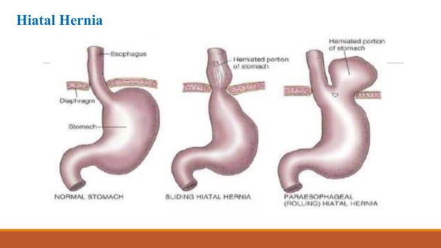 Hernia for nursing | PDF | Digestive Disorders | Diseases and Conditions