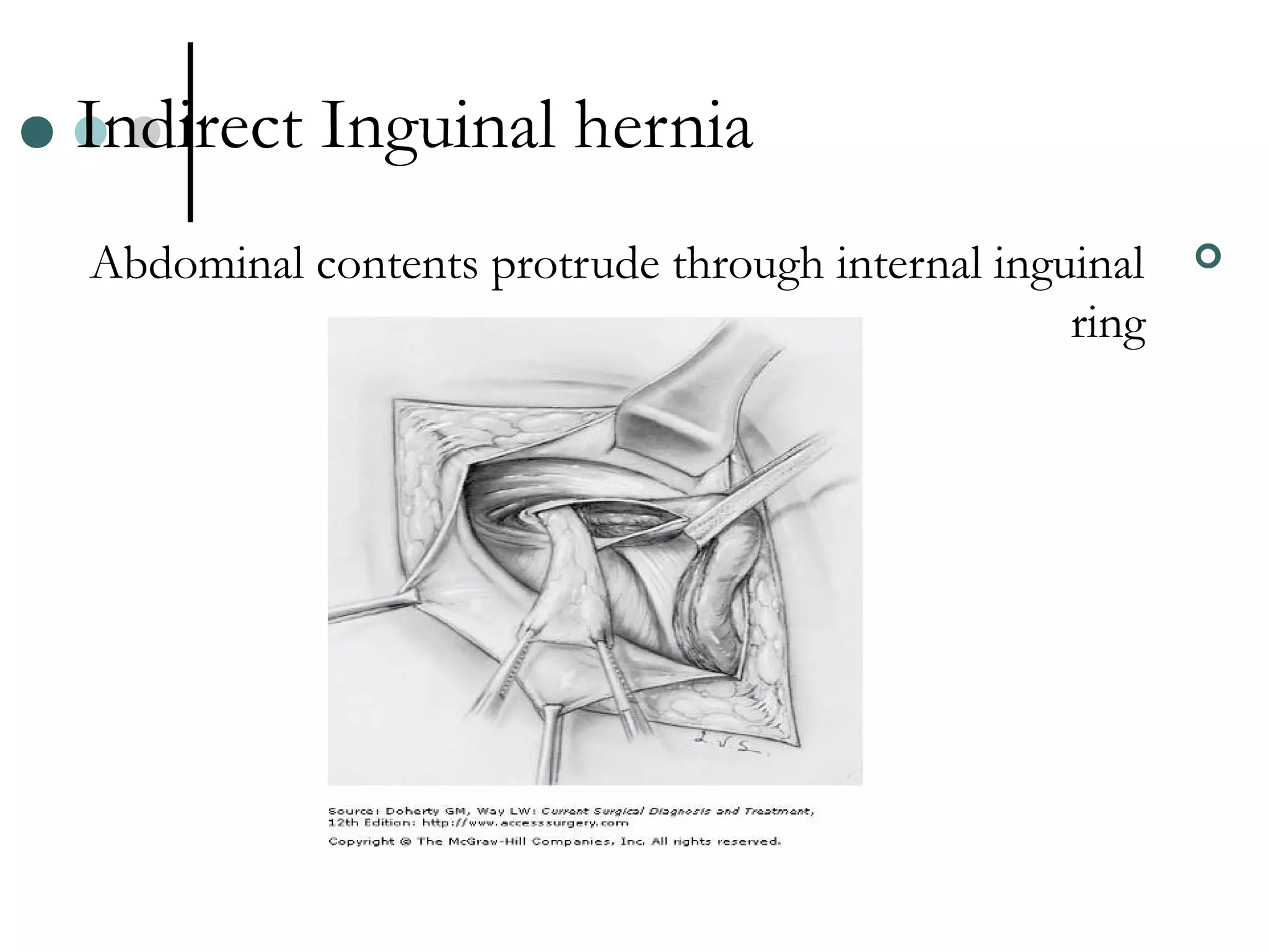 Hernia | PPT