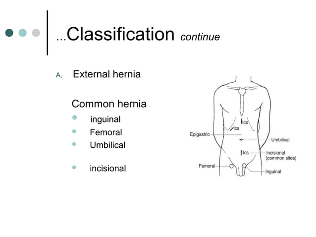 Hernia | PPT