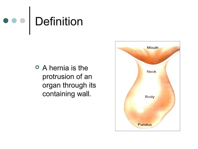 Hernia | PPT