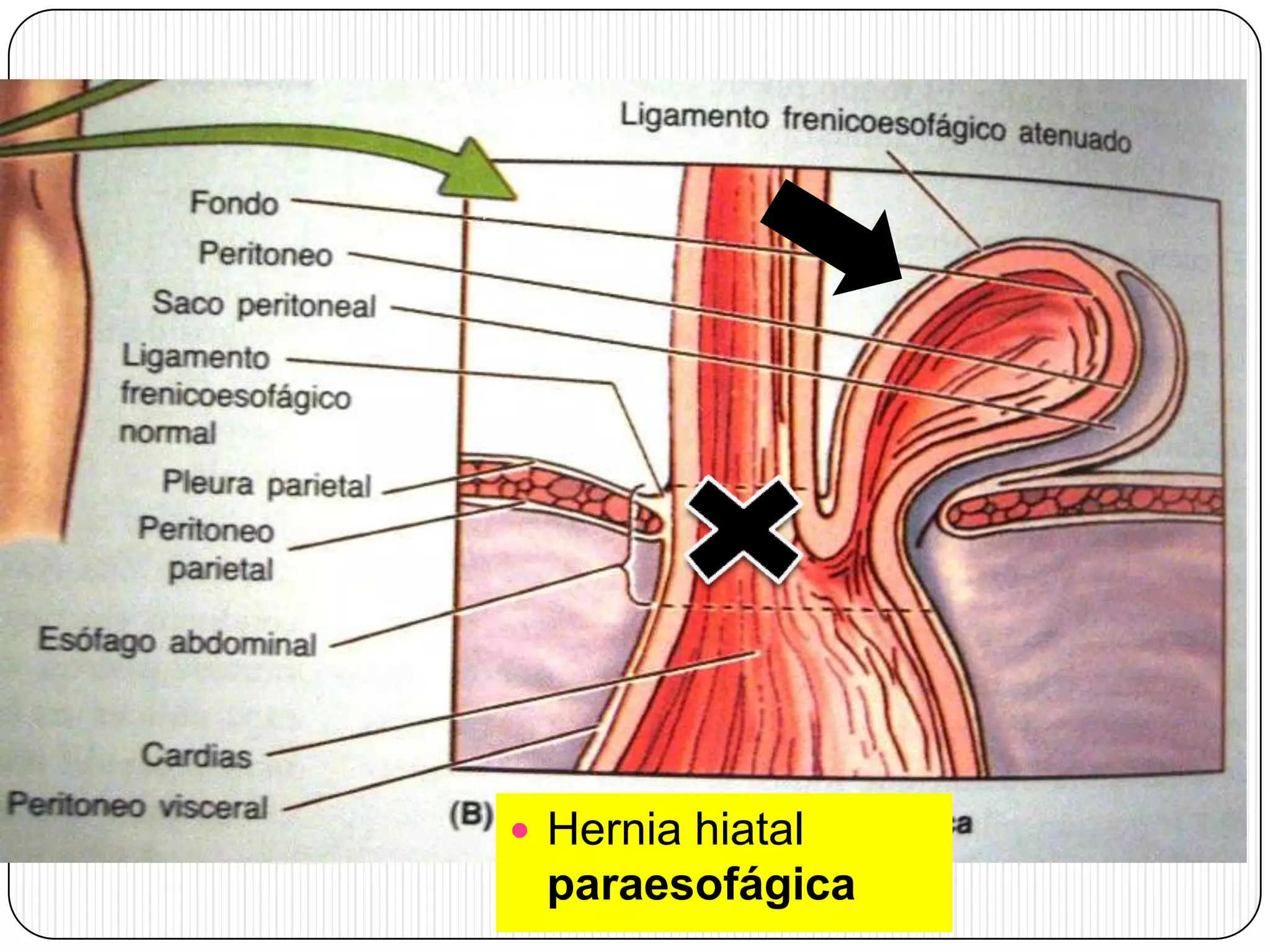 Hernia Hiatal | PPT