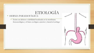 Hernia hiatal | PPTX