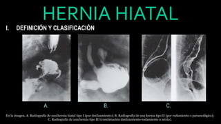 Hernia hiatal | PPTX