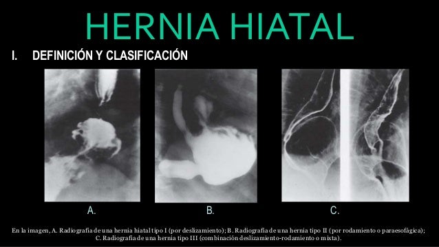 Hernia hiatal
