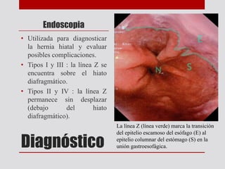 Hernia hiatal | PPTX