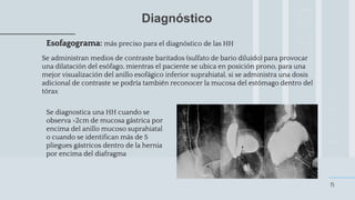 Hernia Hiatal | PPTX