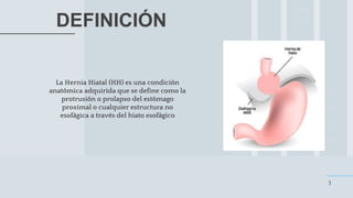 Hernia Hiatal | PPTX