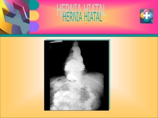 hernia hiatal.pptx