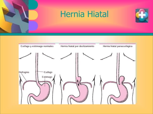 hernia hiatal.pptx