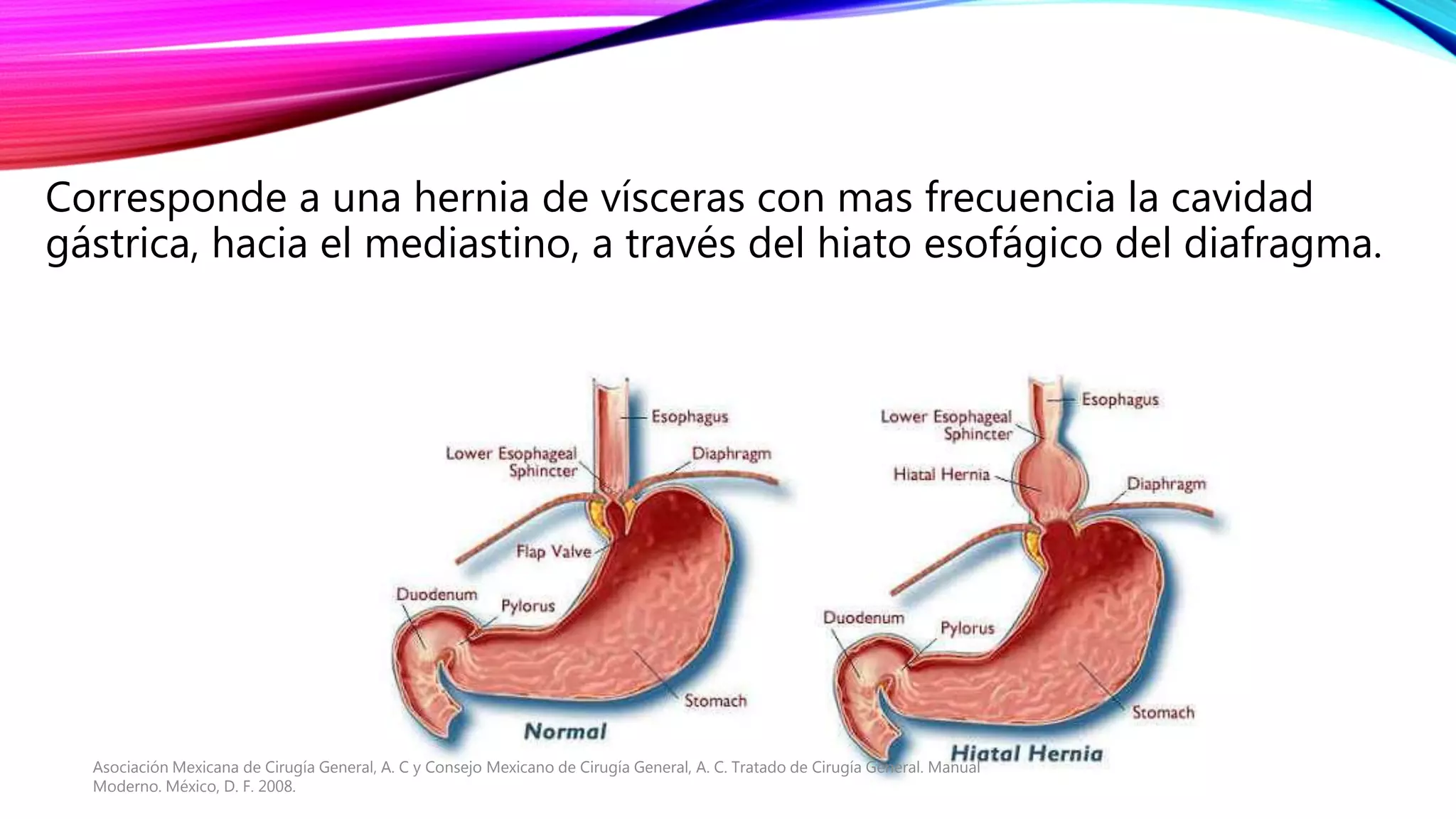 Hernia hiatal y esofago de barret | PPTX